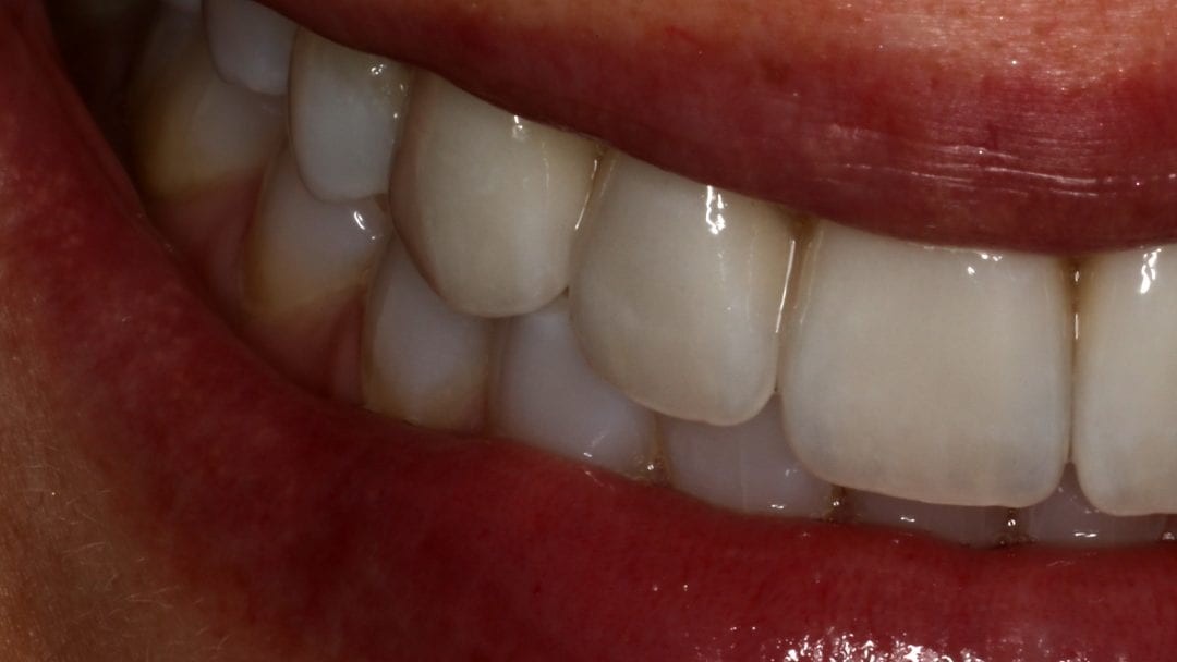 The Benefits of Porcelain Veneer » First Choice Dental