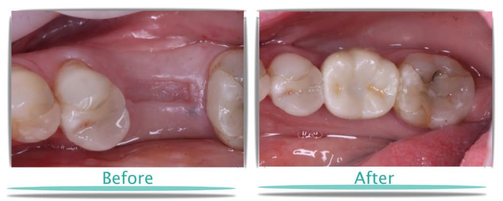 Dental Implants Service in Narellan » First Choice Dental