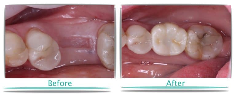 Dental Implants Service in Narellan » First Choice Dental