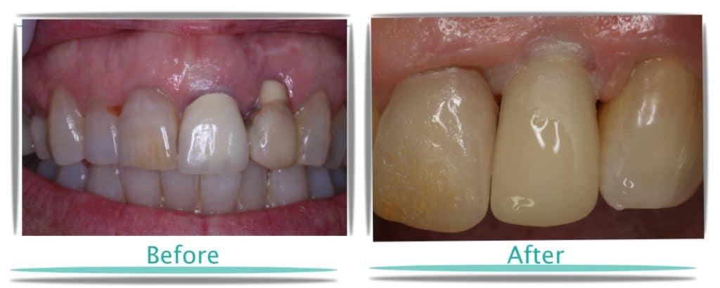 Dental Implants Service in Narellan » First Choice Dental