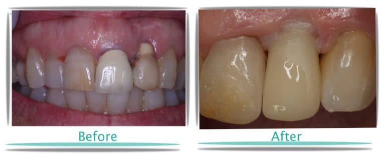 Dental Implants Service in Narellan » First Choice Dental