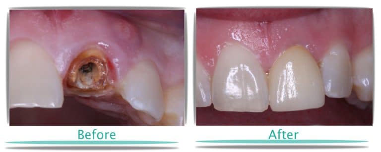 Dental Implants Service in Narellan » First Choice Dental