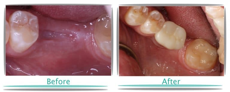 Dental Implants Service in Narellan » First Choice Dental