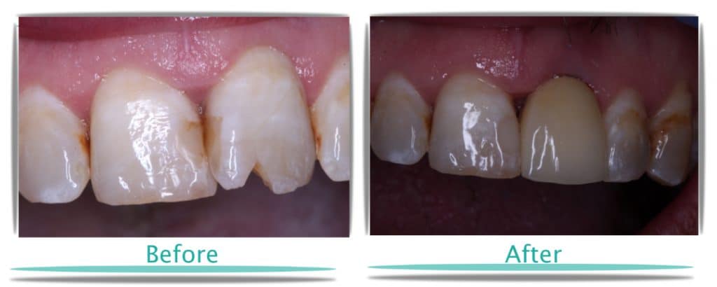 Dental Implants Service in Narellan » First Choice Dental