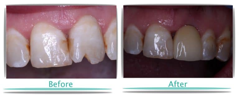 Dental Implants Service in Narellan » First Choice Dental