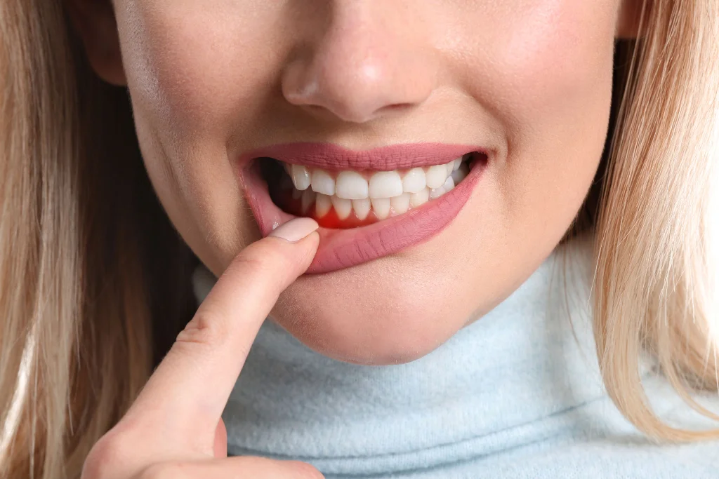 Swollen Gums: Causes, Treatment and When to See a Dentist